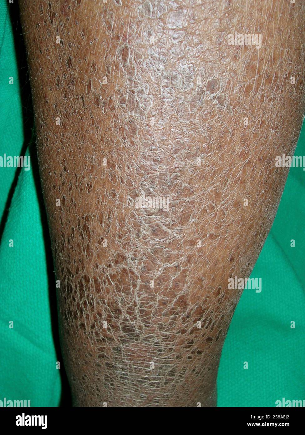 Not to be used for advertising or in a defamatory context Ichthyosis on ...