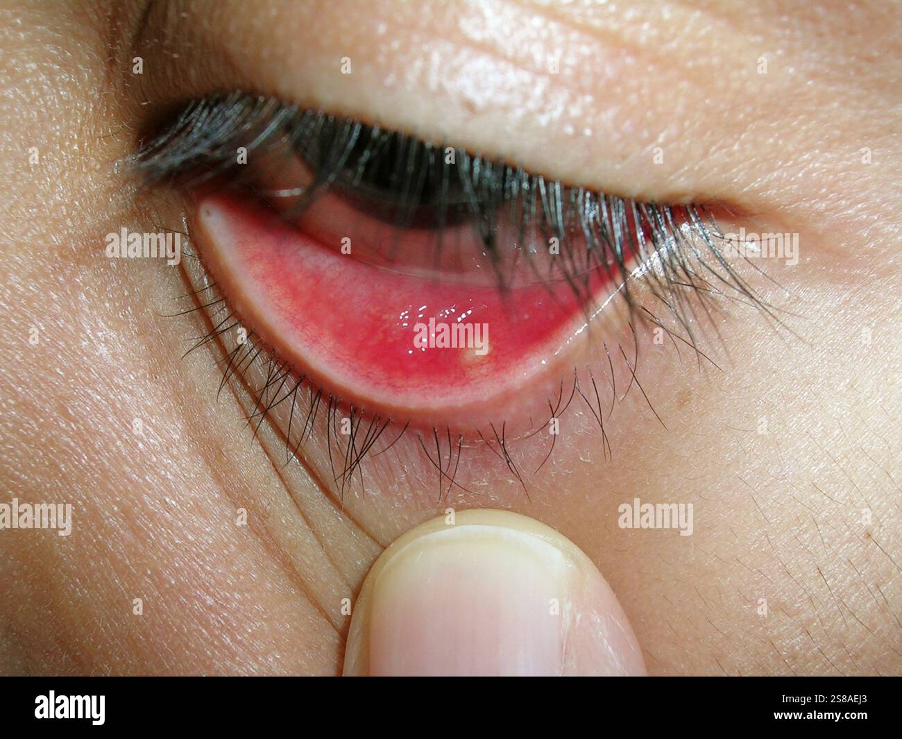 Editorial use only Stye on a patient's inner eyelid. A stye, or hordeolum, is a bacterial ...