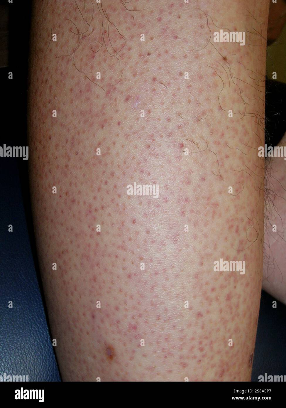 Not to be used for advertising or in a defamatory context Rash on the ...