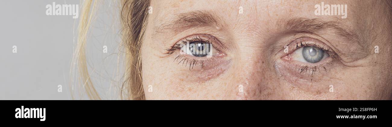 Close-Up of Human Eye with Medical Issues Stock Photo - Alamy