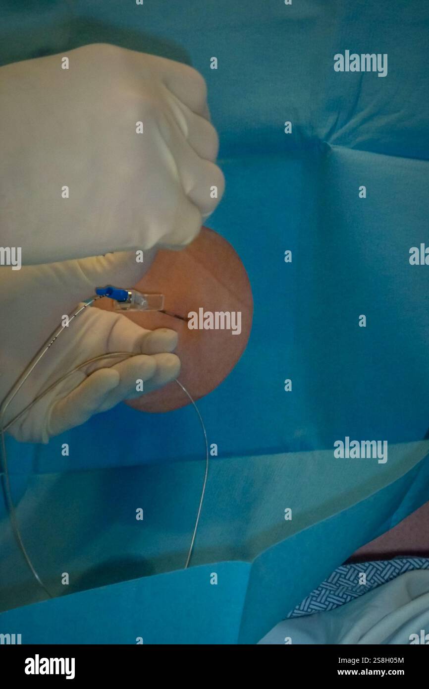 Epidural needle being injected in person Stock Photo - Alamy