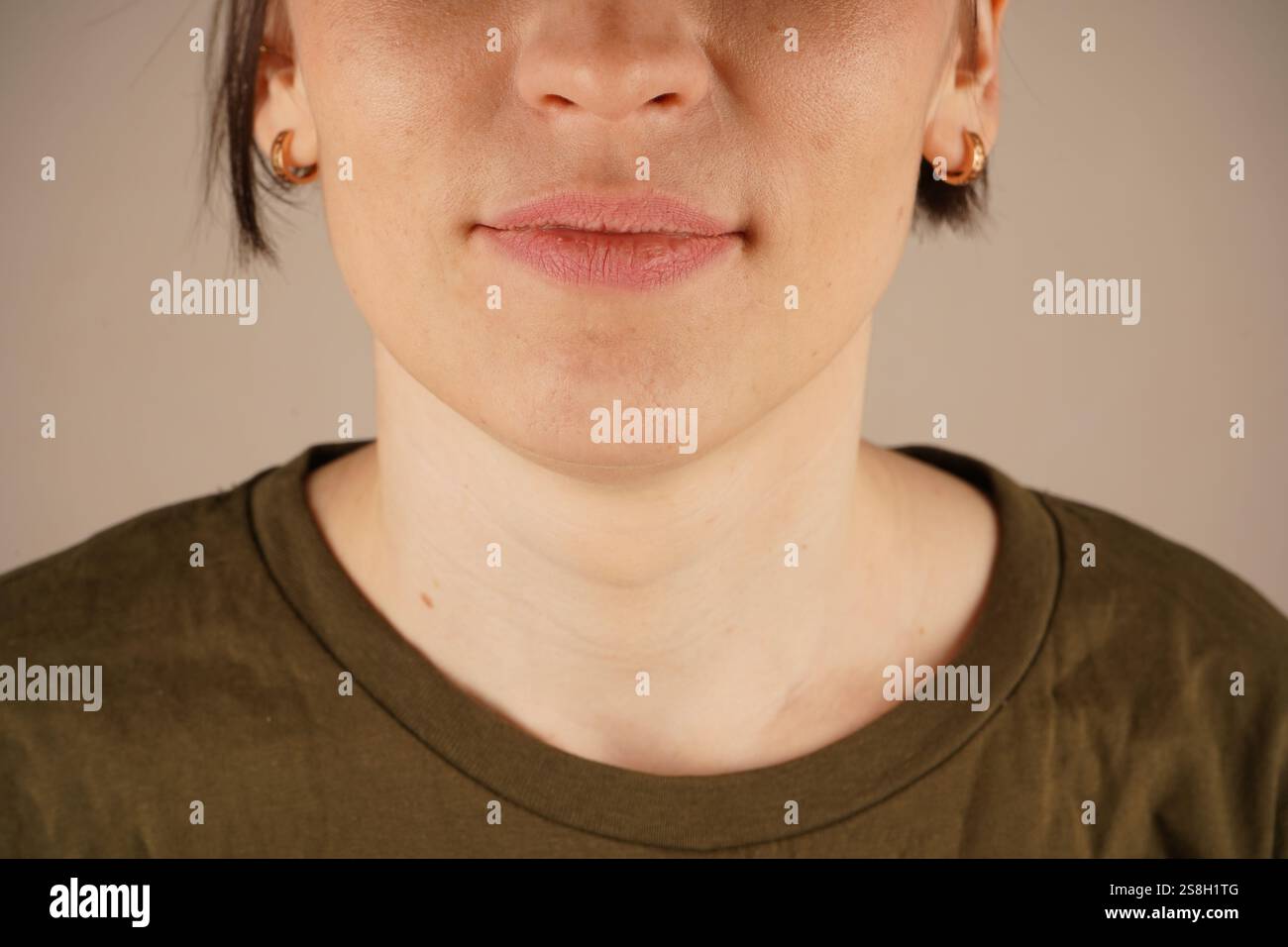 Women lips correction before and after comparison. Hyaluronic acid ...