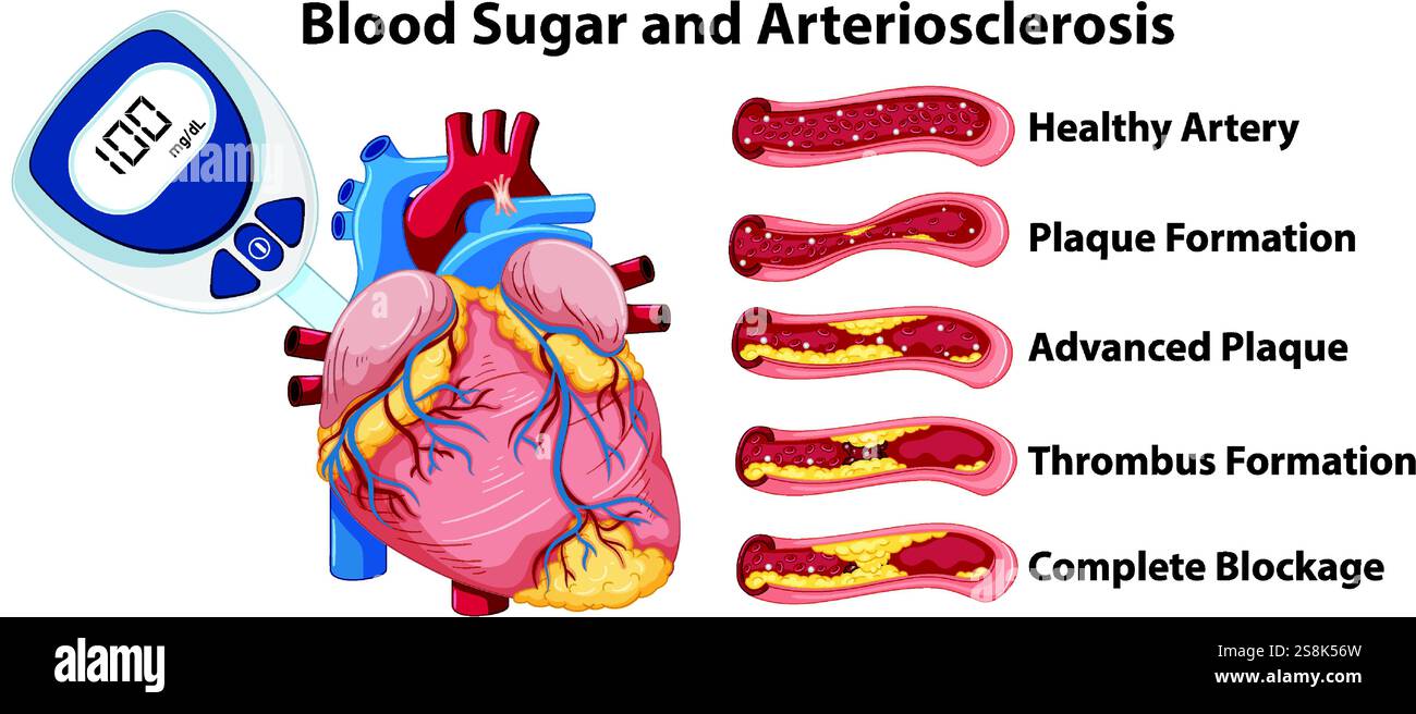 Diagram showing artery health stages and heart anatomy Stock Vector ...