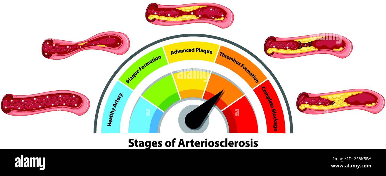 Illustration of artery health and plaque buildup stages Stock Vector ...