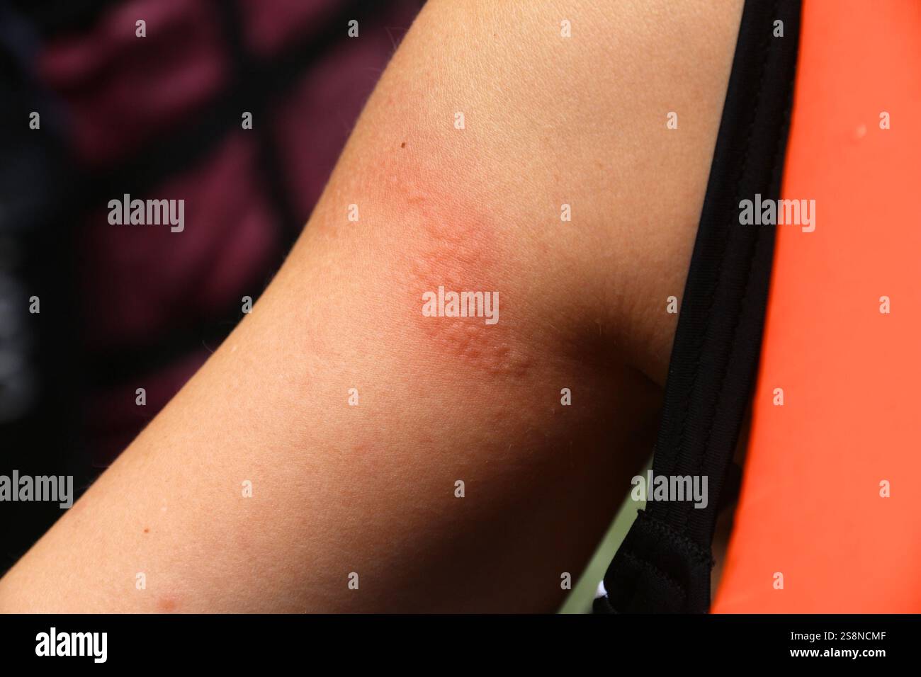 Jellyfish sting mark on woman tourist's arm in Palawan island ...