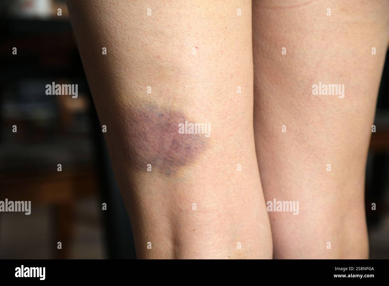 Bruise on the leg of a woman. Hematoma contusion after winter sports ...