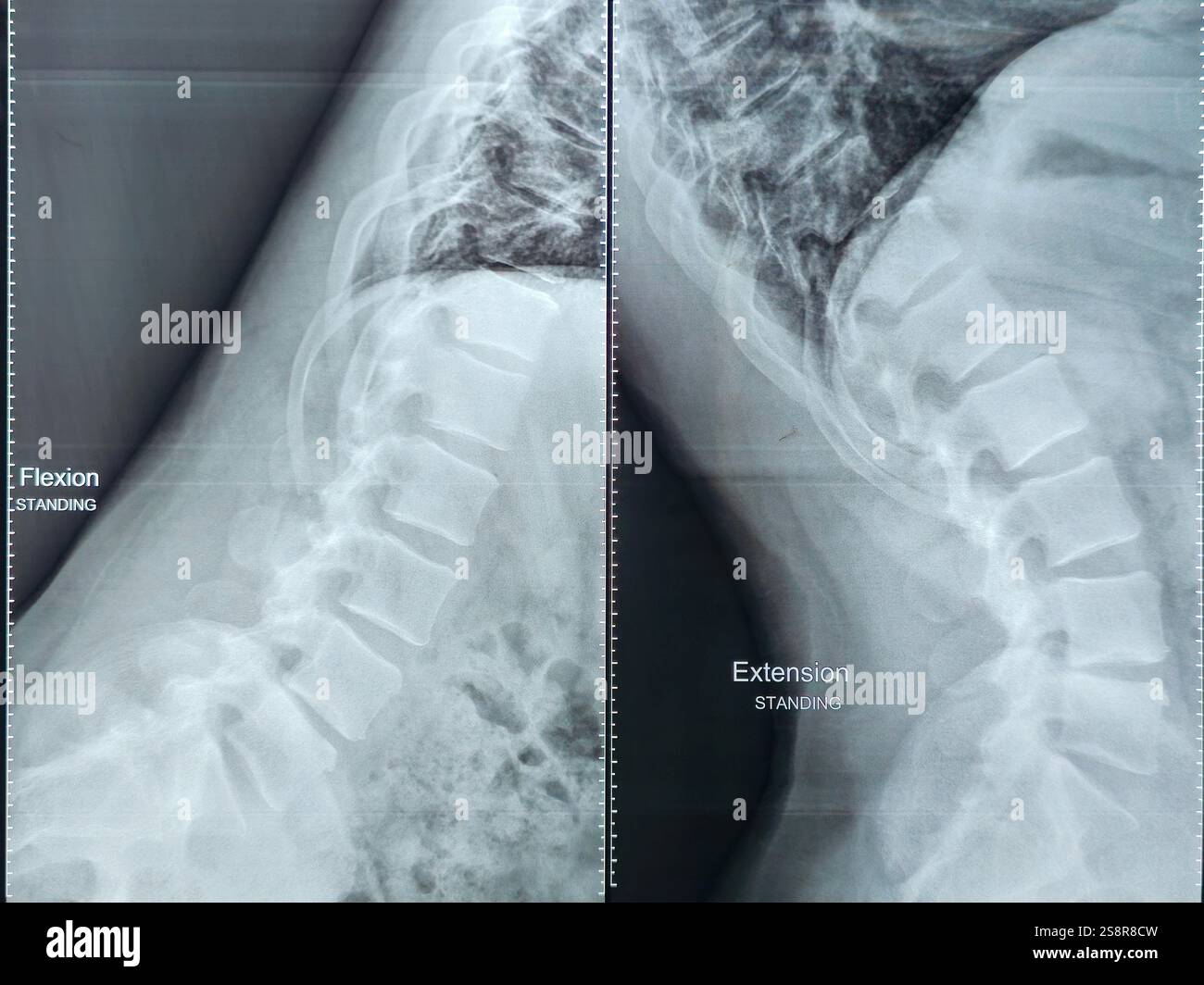 X-ray lumbosacral spine shows straightening of lumbar lordosis due to ...