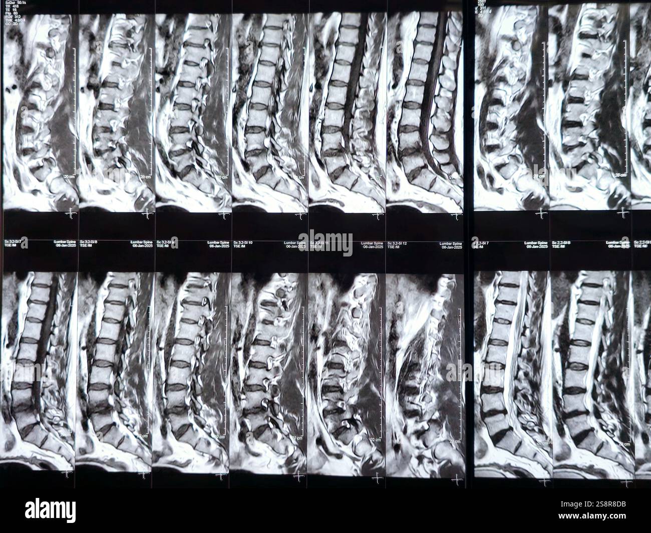 Magnetic Resonance Imaging MRI of the lumbosacral spine shows Spondylodegenerative changes of ...
