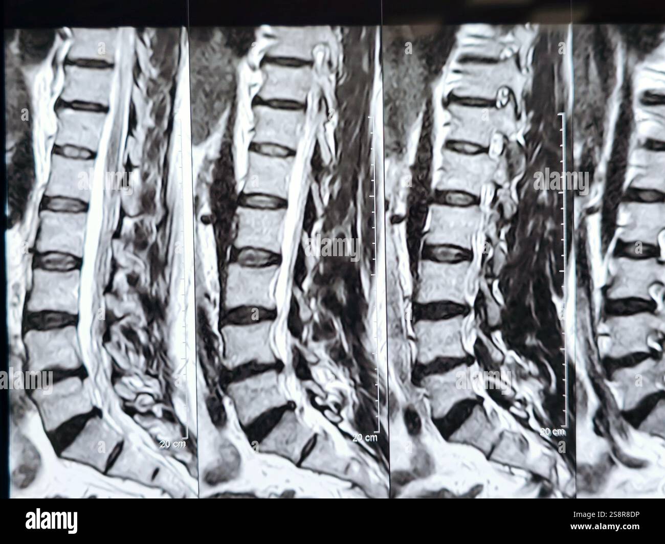 Magnetic Resonance Imaging MRI of the lumbosacral spine shows ...