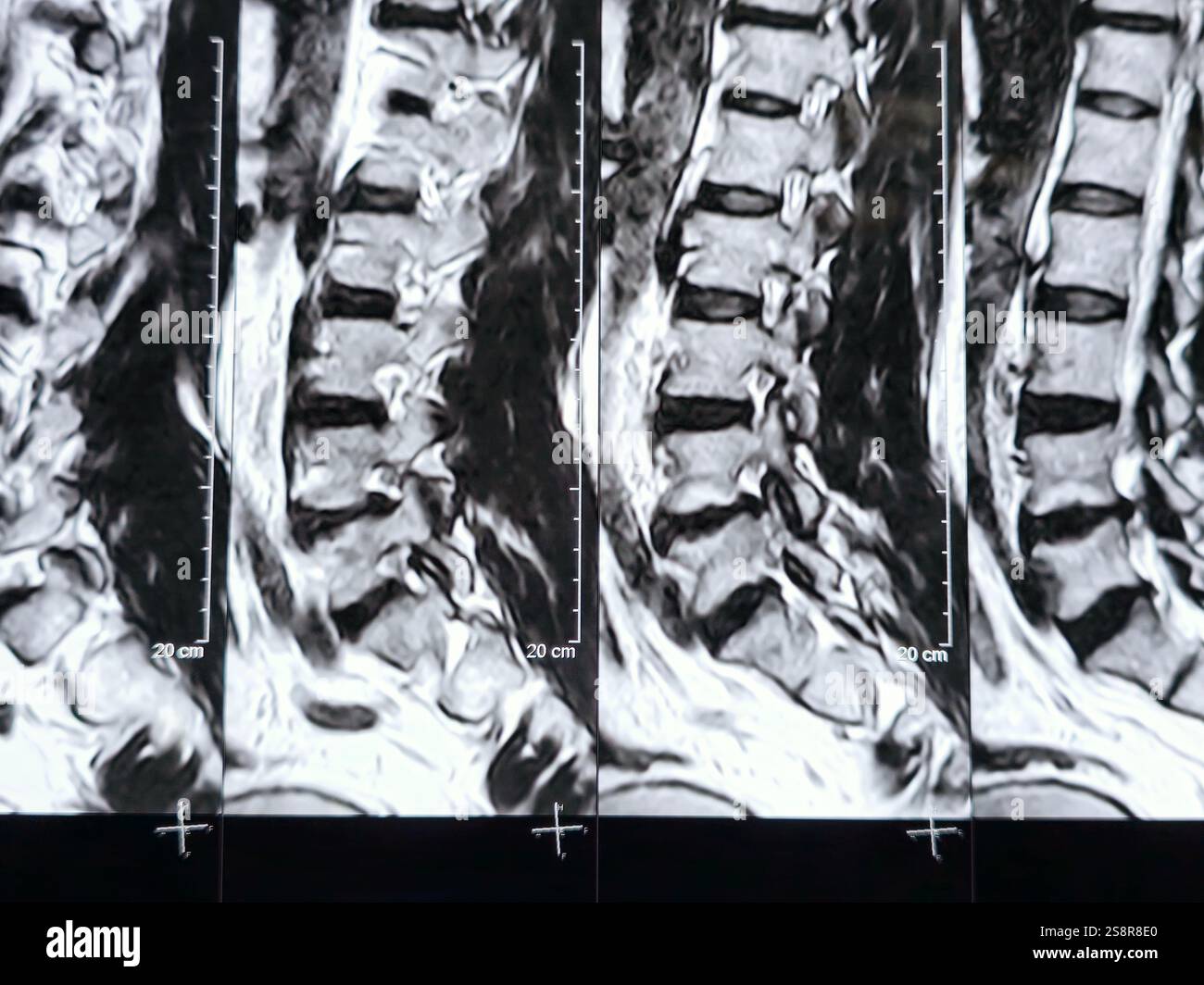Magnetic Resonance Imaging MRI of the lumbosacral spine shows Spondylodegenerative changes of ...