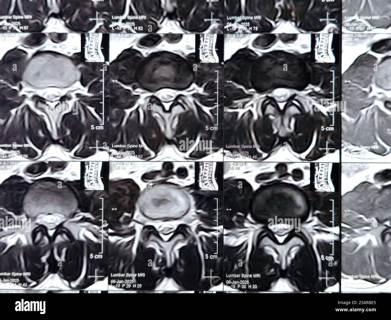 Magnetic Resonance Imaging MRI of the lumbosacral spine shows Spondylodegenerative changes of ...