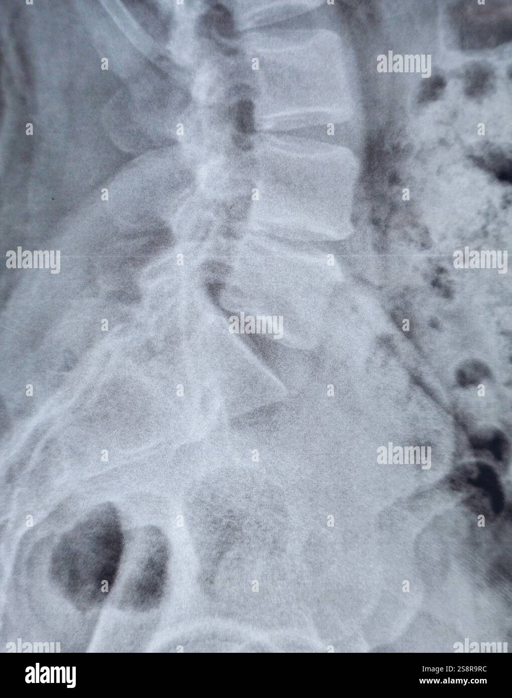 X-ray lumbosacral spine shows straightening of lumbar lordosis due to ...