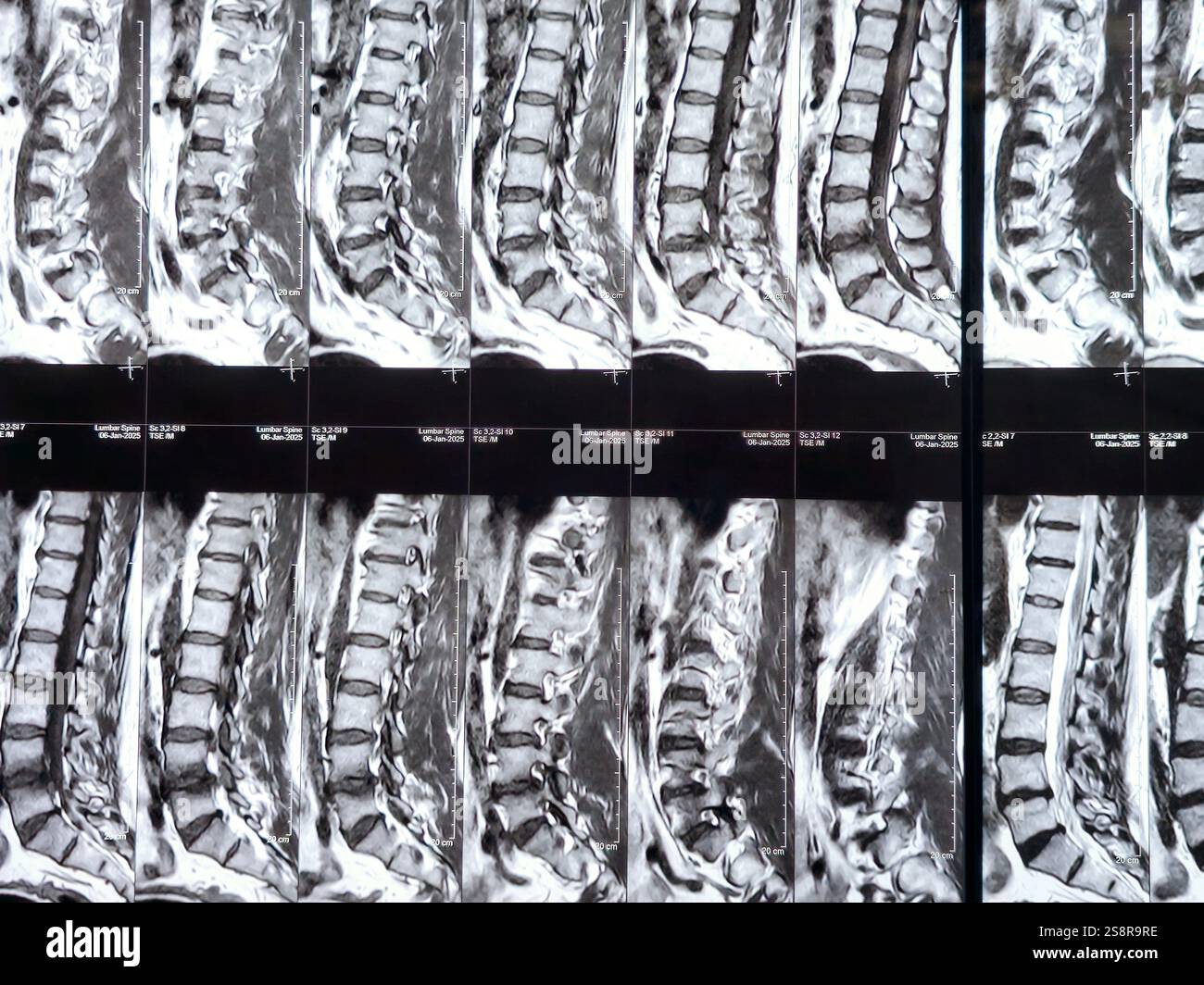 Magnetic Resonance Imaging MRI of the lumbosacral spine shows ...