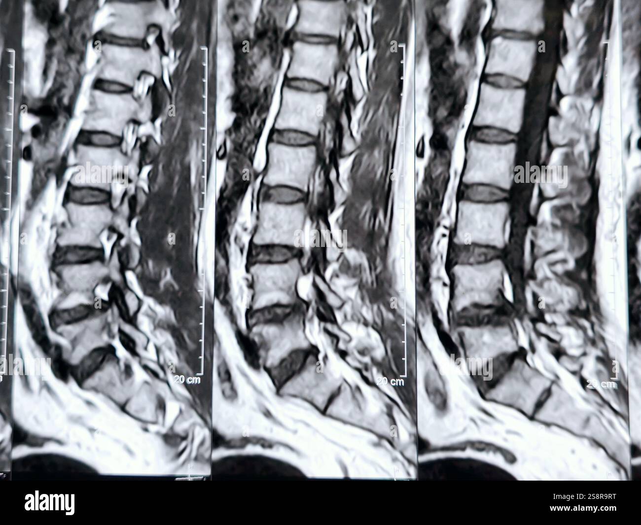 Magnetic Resonance Imaging MRI of the lumbosacral spine shows Spondylodegenerative changes of ...