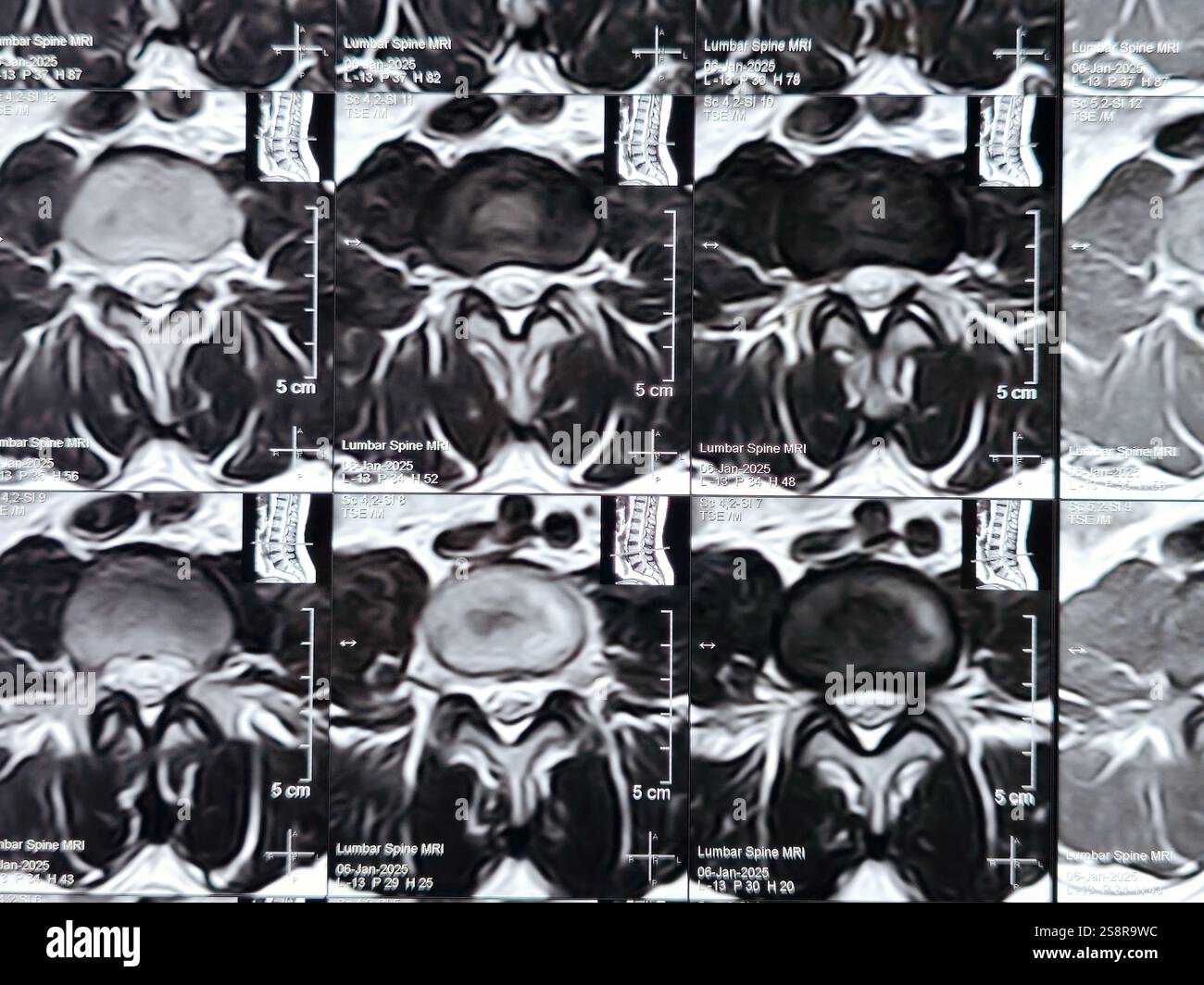 Magnetic Resonance Imaging MRI of the lumbosacral spine shows ...