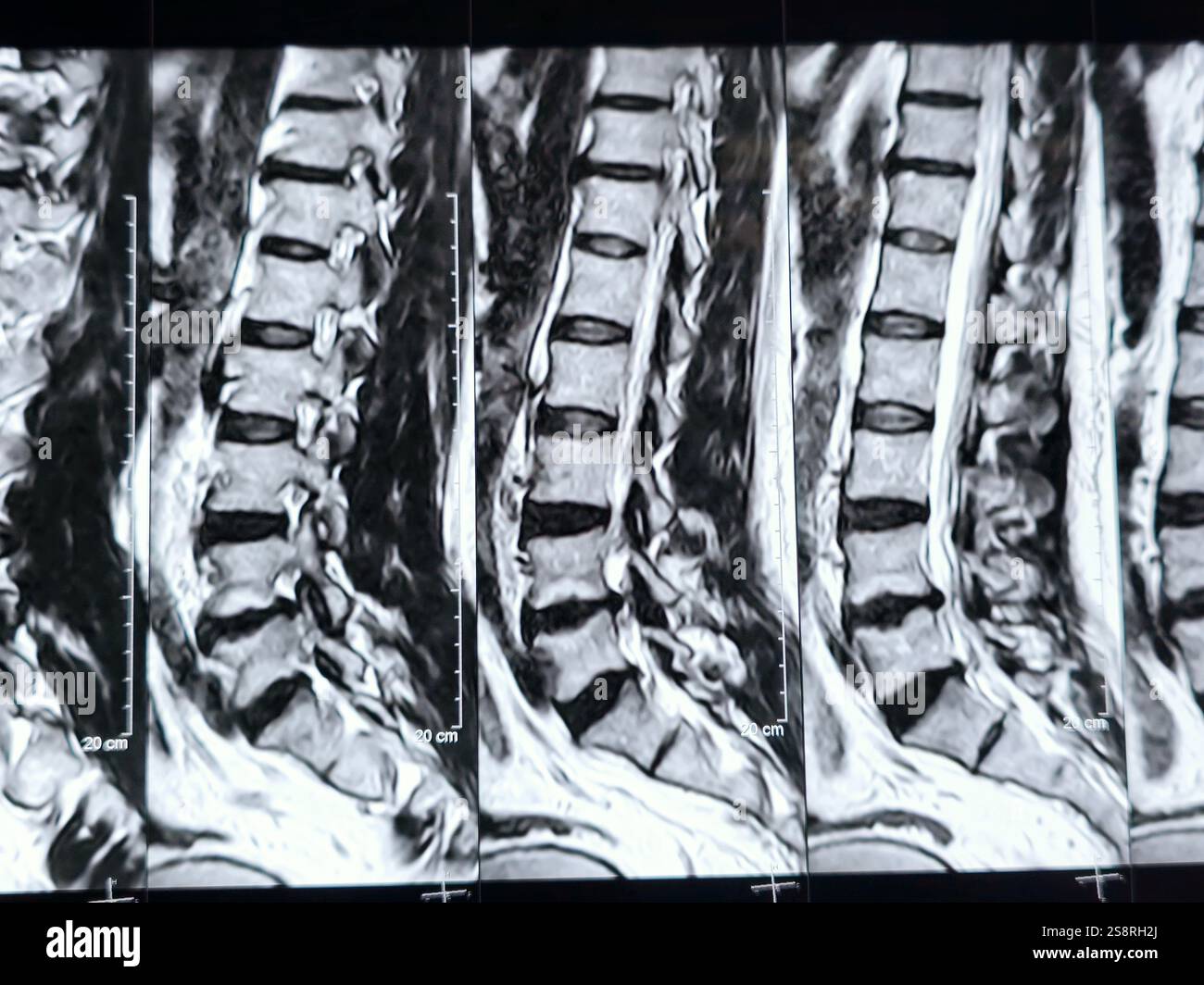Magnetic Resonance Imaging MRI of the lumbosacral spine shows ...