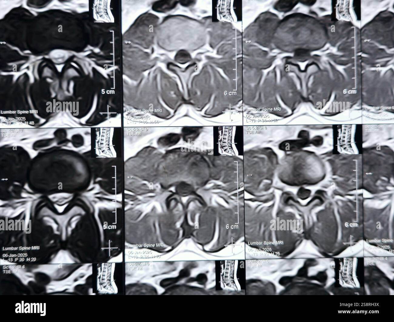 Magnetic Resonance Imaging MRI of the lumbosacral spine shows Spondylodegenerative changes of ...