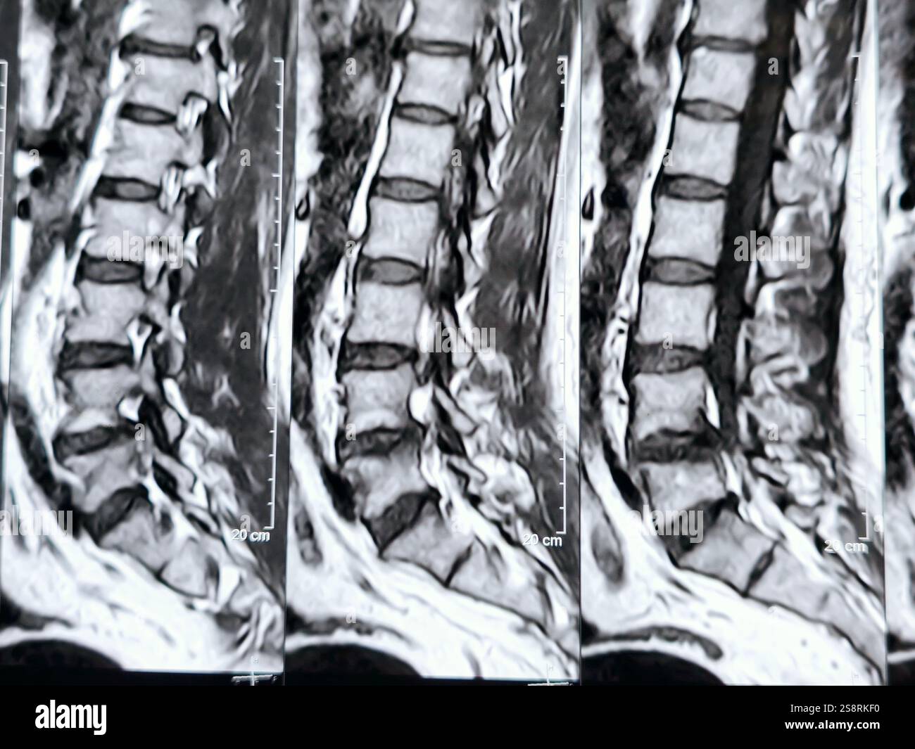 Magnetic Resonance Imaging MRI of the lumbosacral spine shows ...