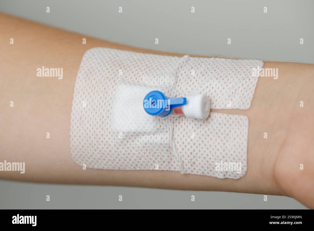 Medical device. Peripheral Catheter for Multiday Therapy Stock Photo ...