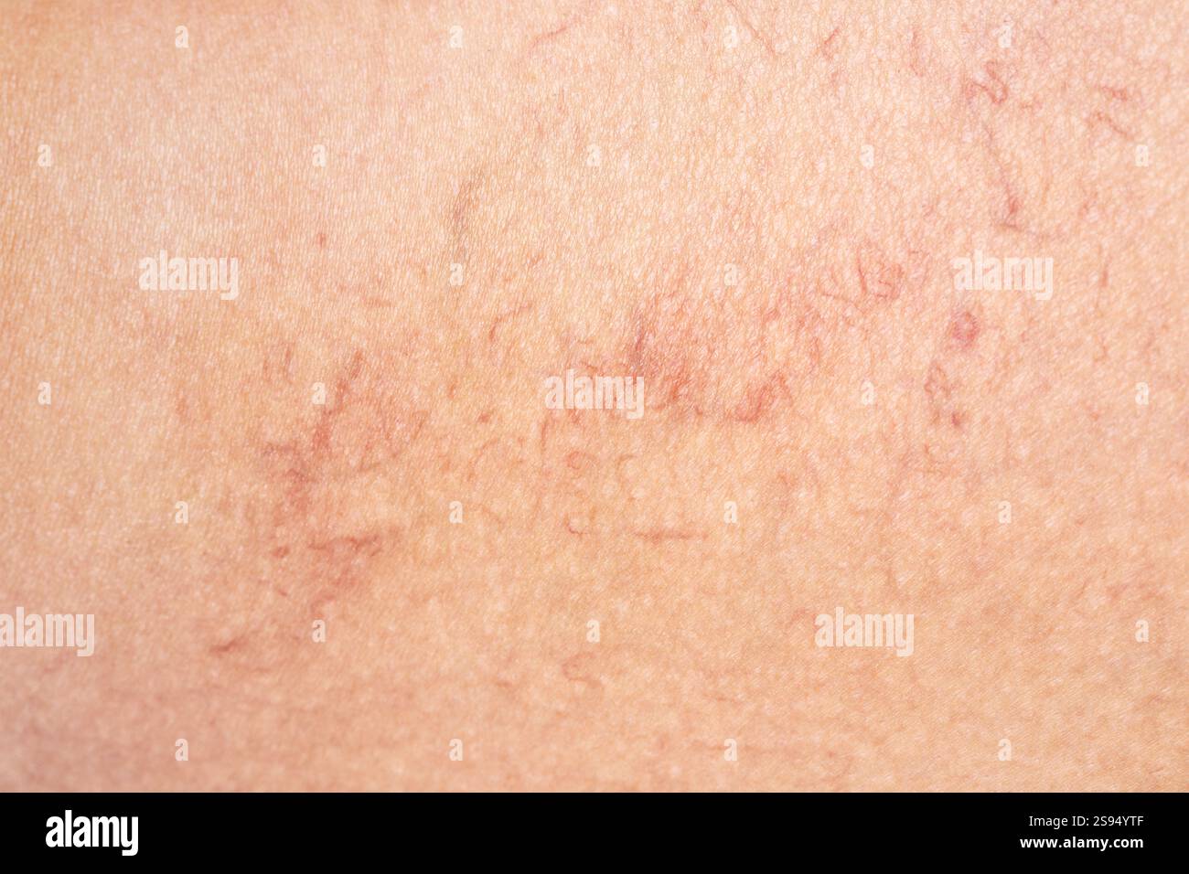 Removal of varicose veins on the legs. Medical inspection and treatment ...