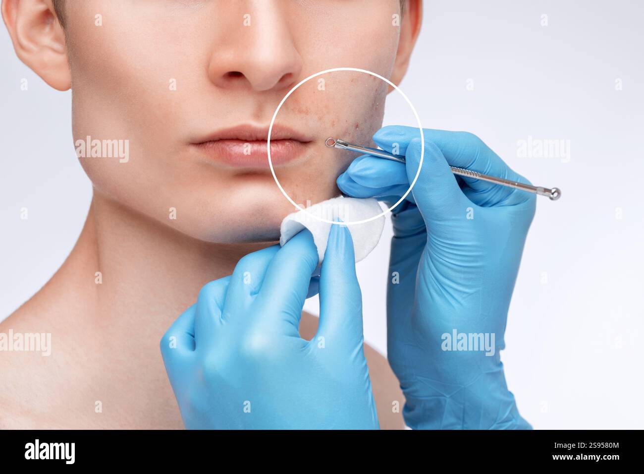 A young guy with problem skin on his face. Photos before and after acne ...