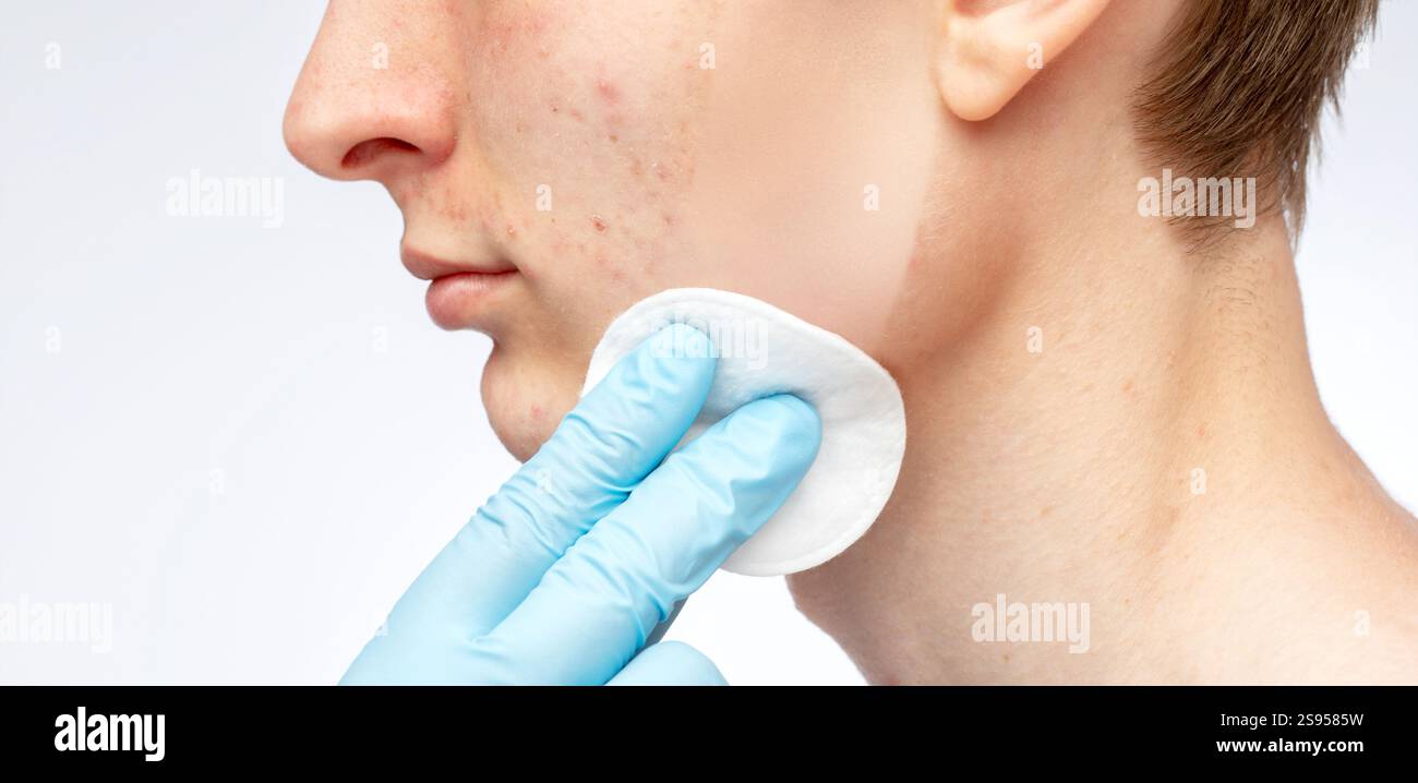 A young guy with problem skin on his face. Photos before and after acne ...