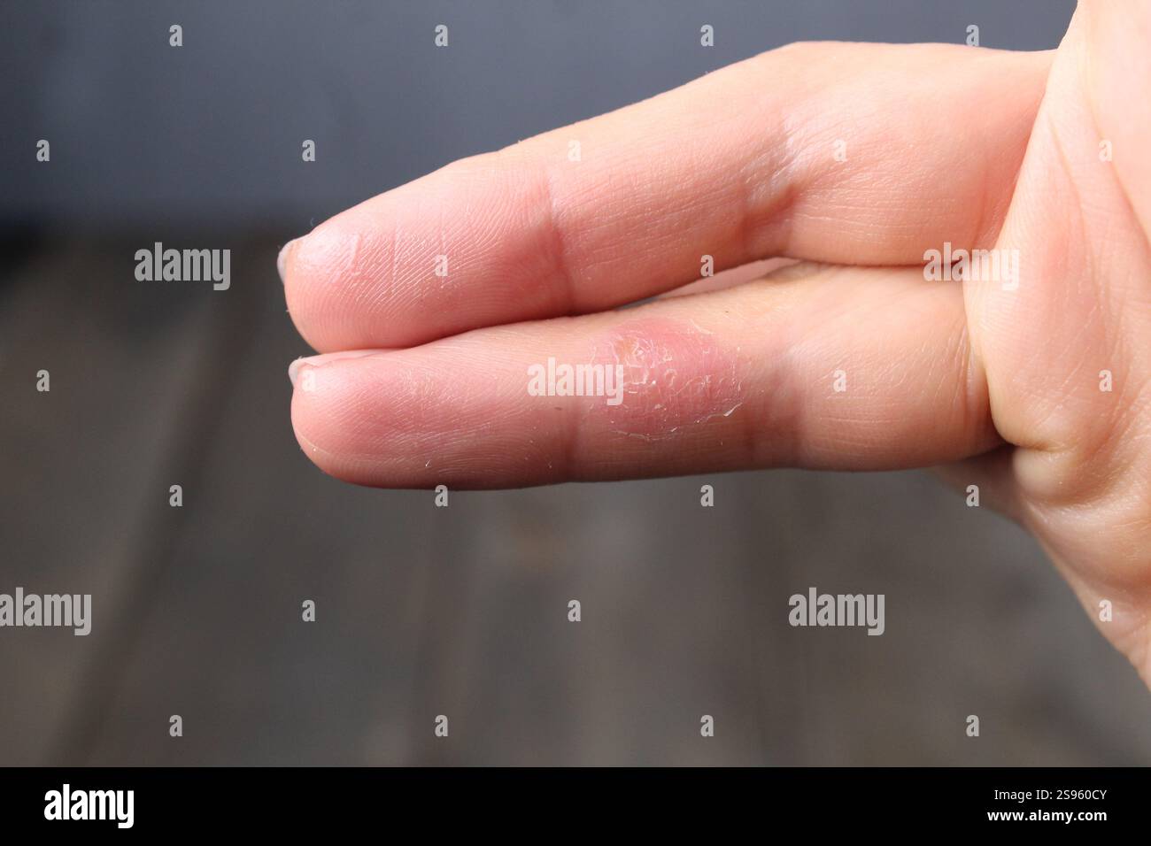 fingers with traces of calluses. Skin disease lesions. Hand Care Stock ...