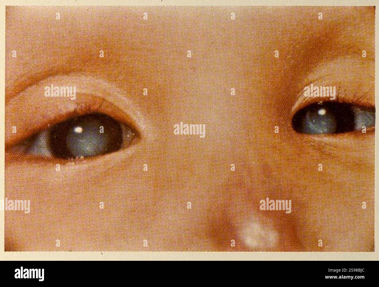 Hallerman-Streiff Syndrome 3 Stock Photo - Alamy