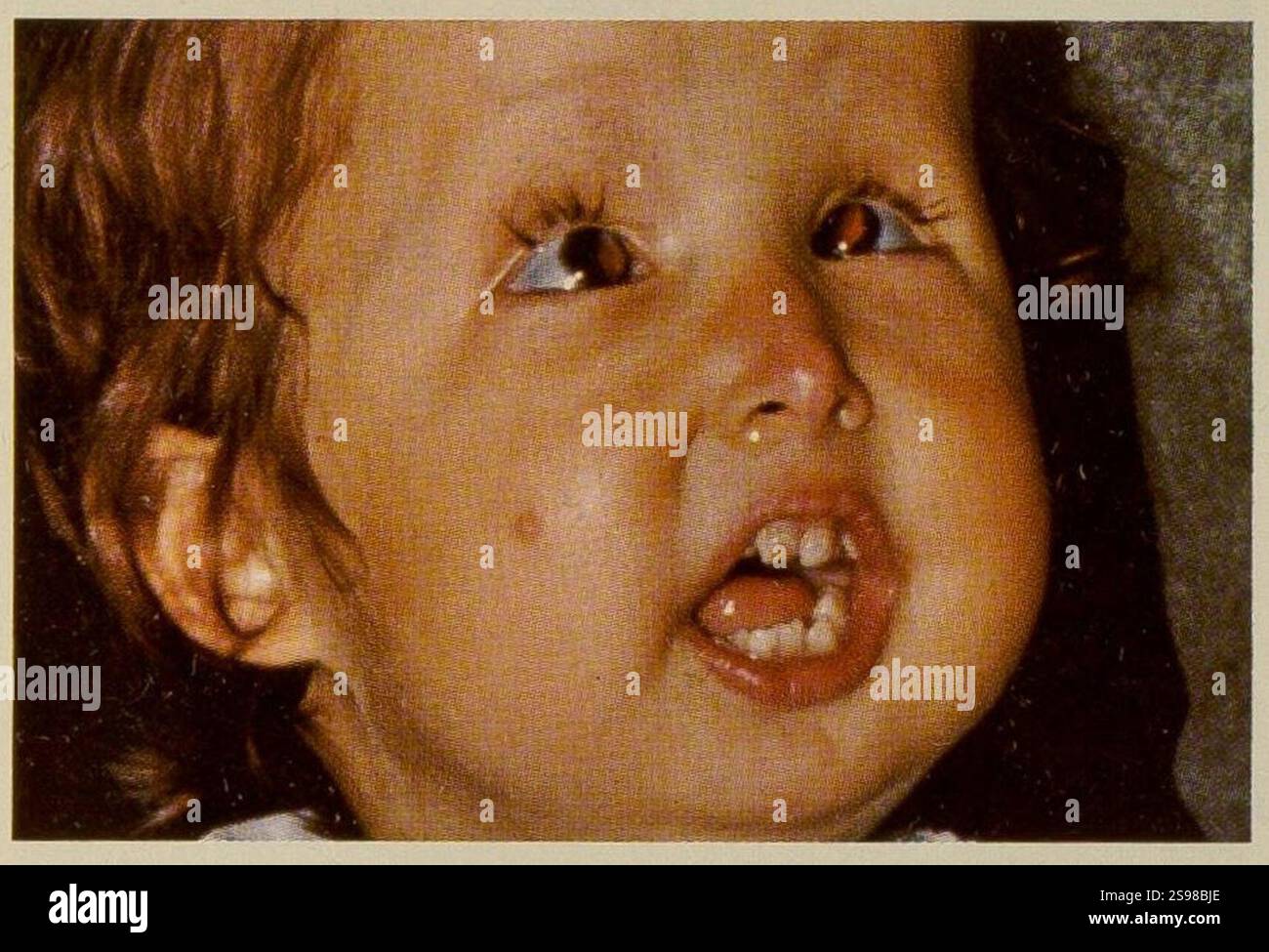 Hallerman-Streiff Syndrome 4 Stock Photo - Alamy