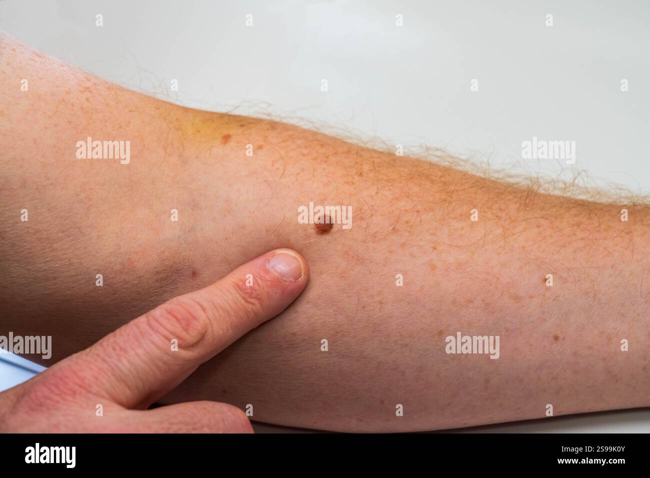 Title Finger pointing to a brown mole on skin with freckles, a skin ...