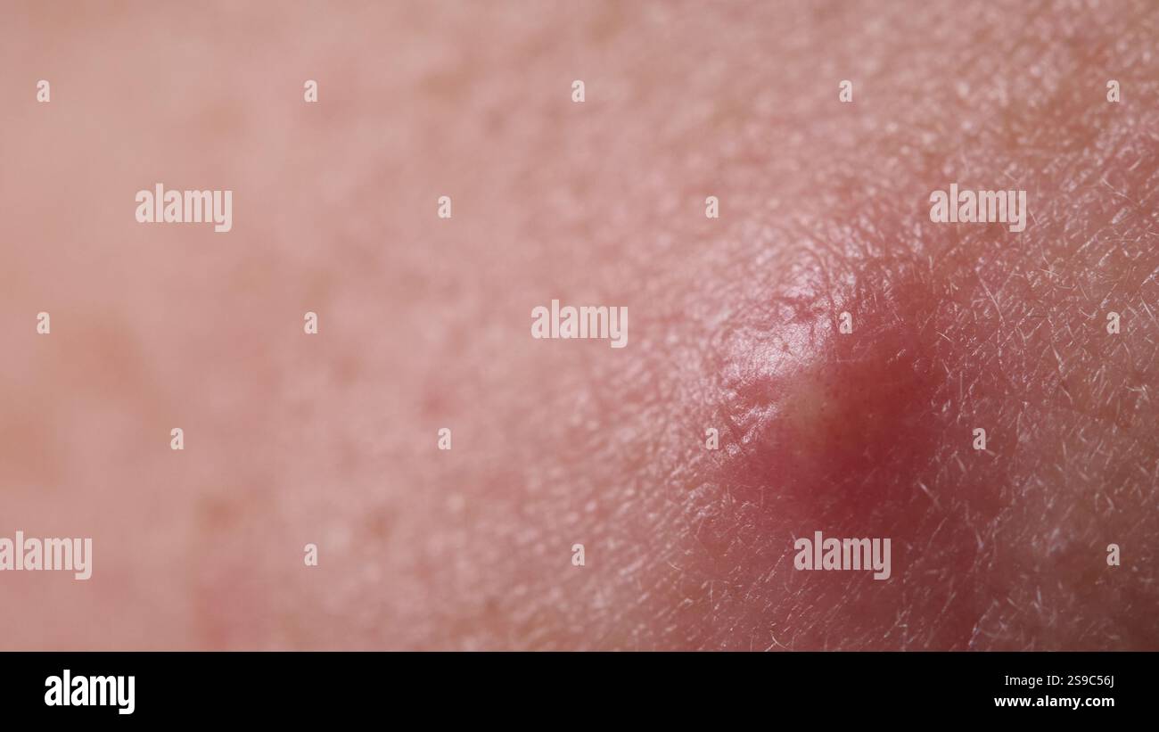 Pimple on the skin. Acne is an infection that can lead to pimple ...