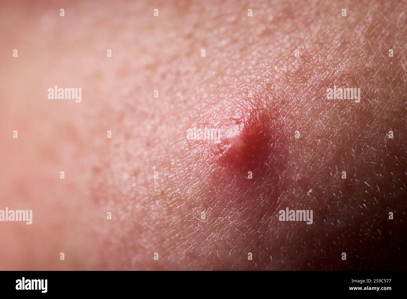 Pimple on the skin. Acne is an infection that can lead to pimple ...