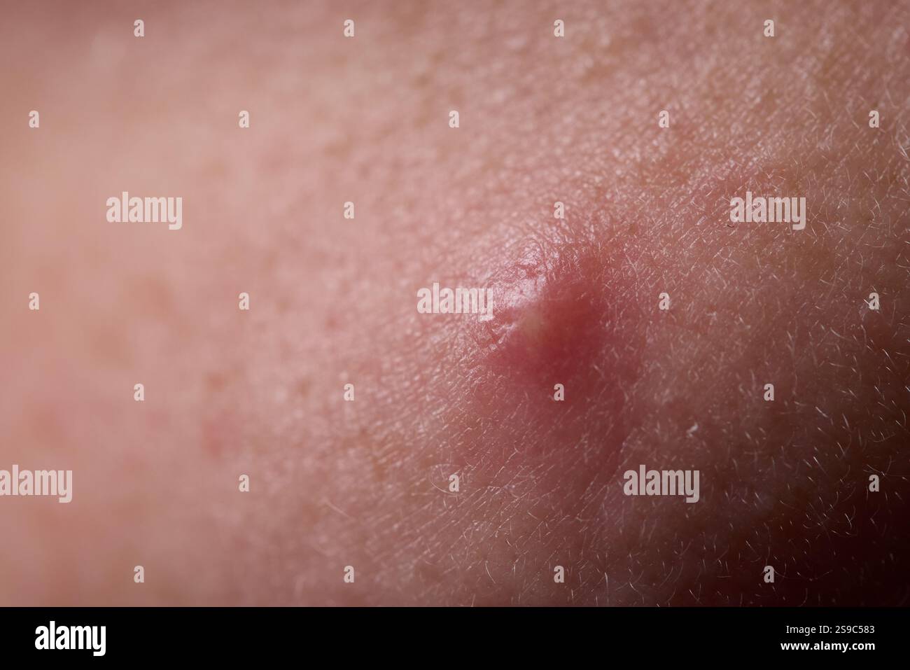 Pimple on the skin. Acne is an infection that can lead to pimple ...