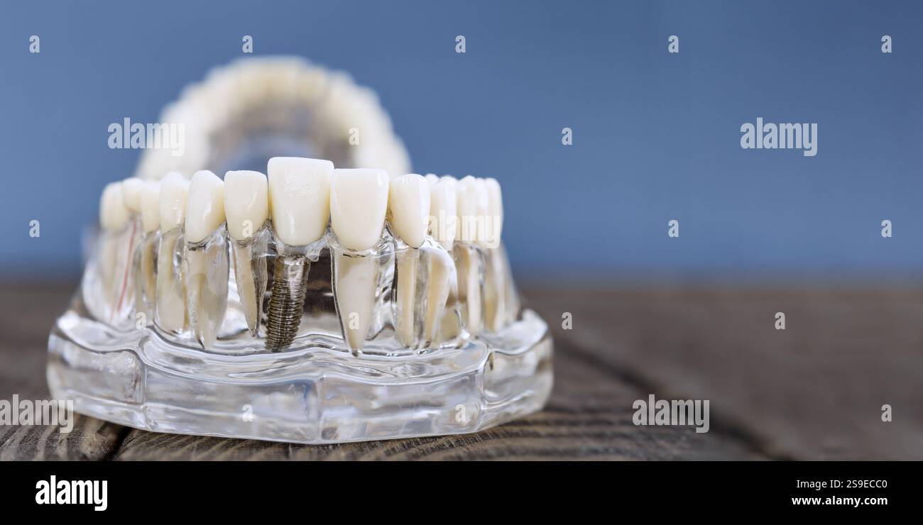 Dental Implant Model Showcasing Prosthetic Teeth on a Transparent Jaw ...