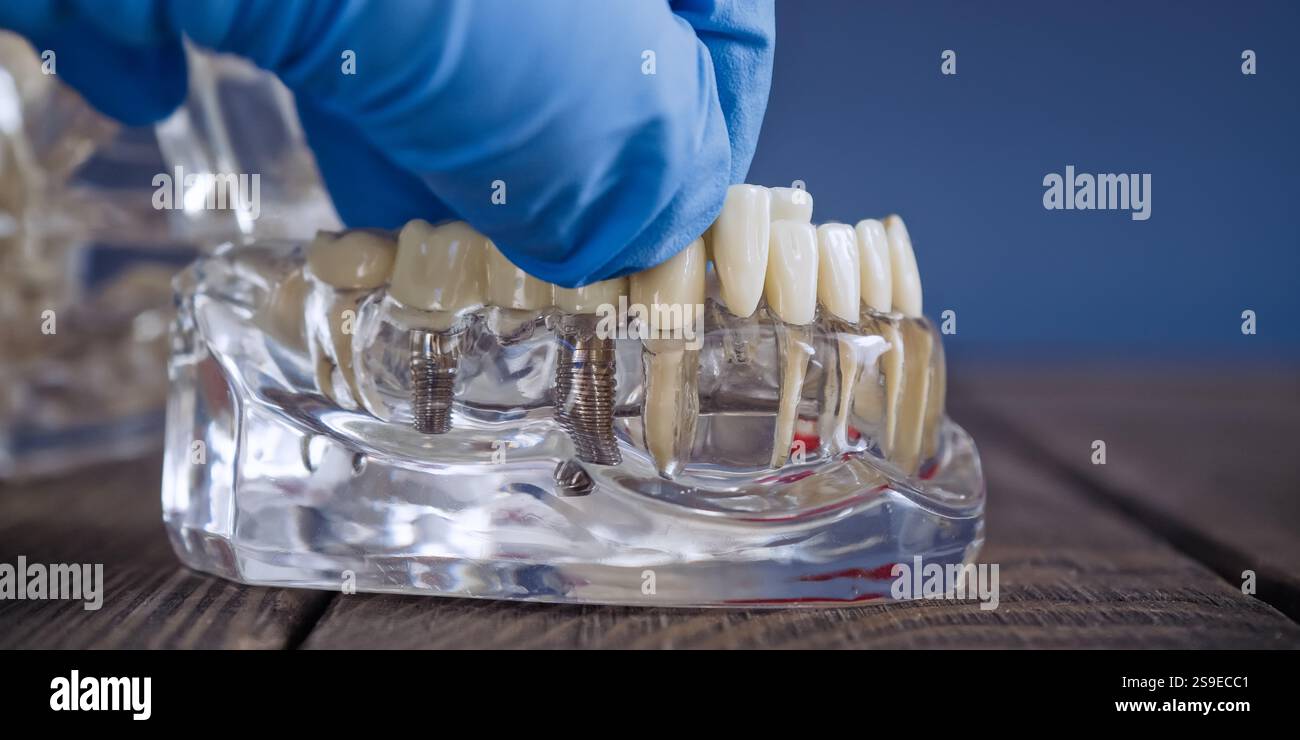 Side View of a Dental Implant Model with a Gloved Hand Adjusting ...