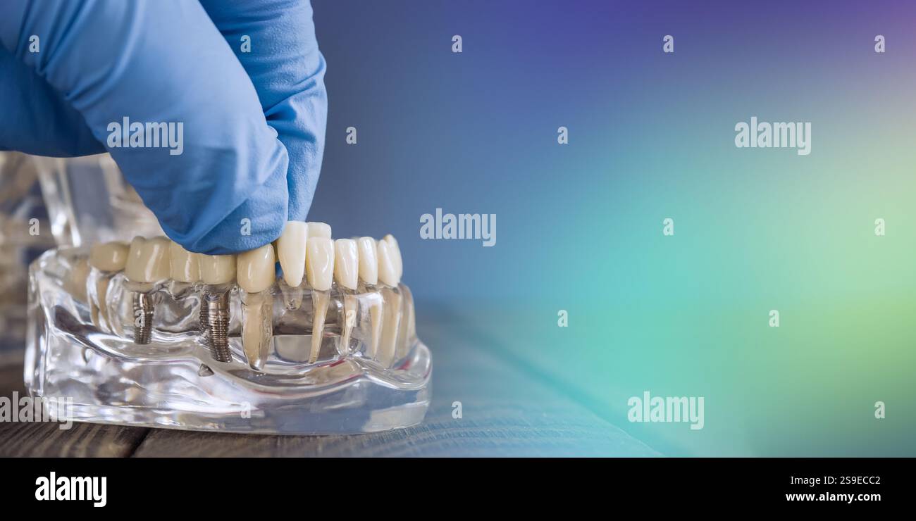 Close-up of a dental implant model with a gloved hand showing the ...