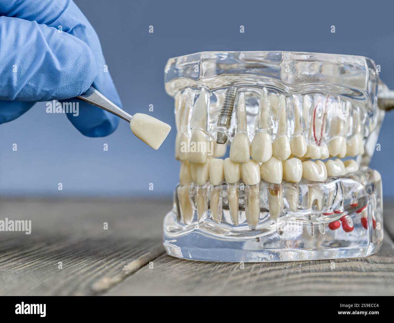 Detailed Transparent Dental Implant Model with Tweezers Holding a ...