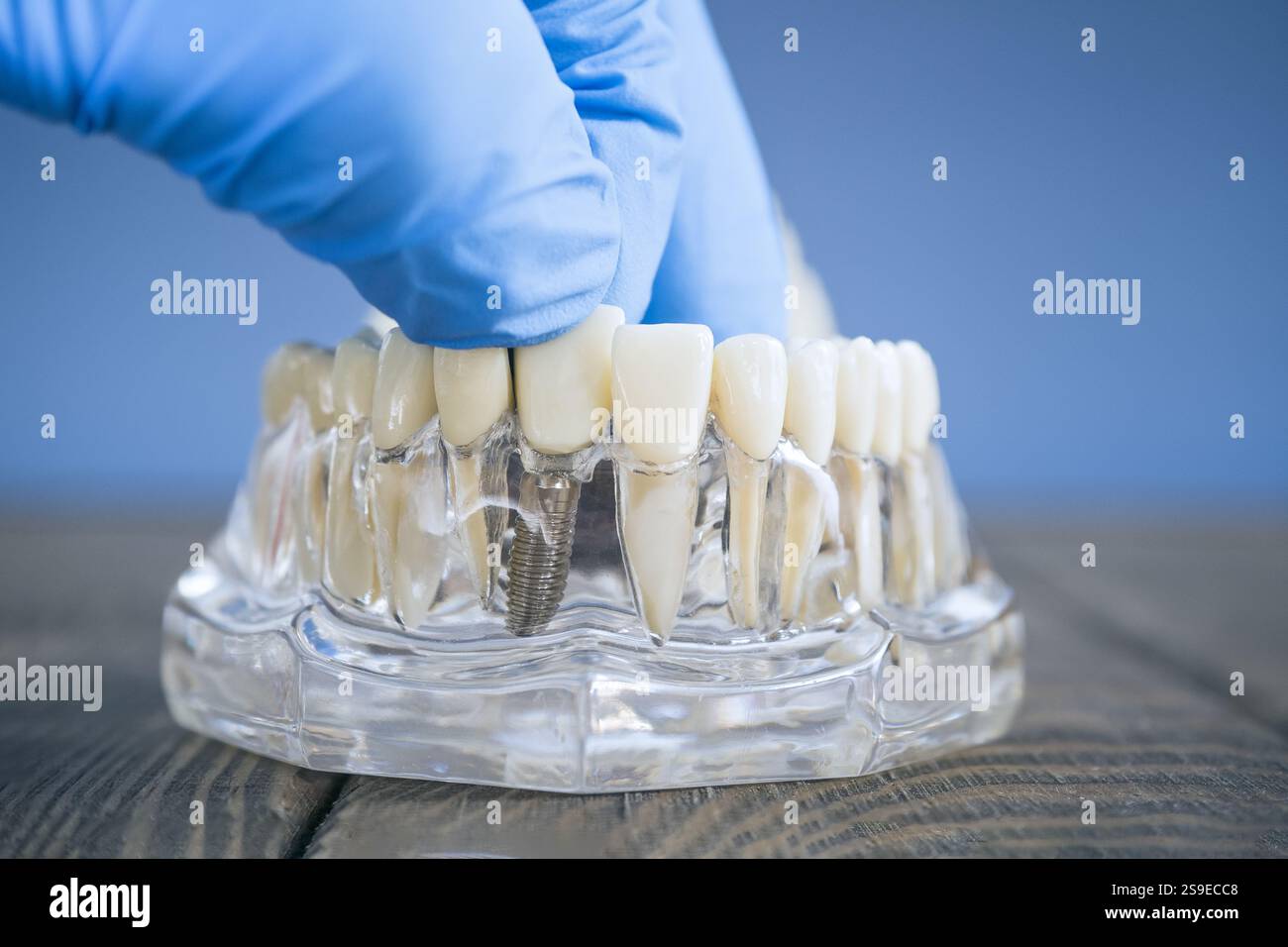 Side View of a Dental Implant Model with a Gloved Hand Adjusting ...