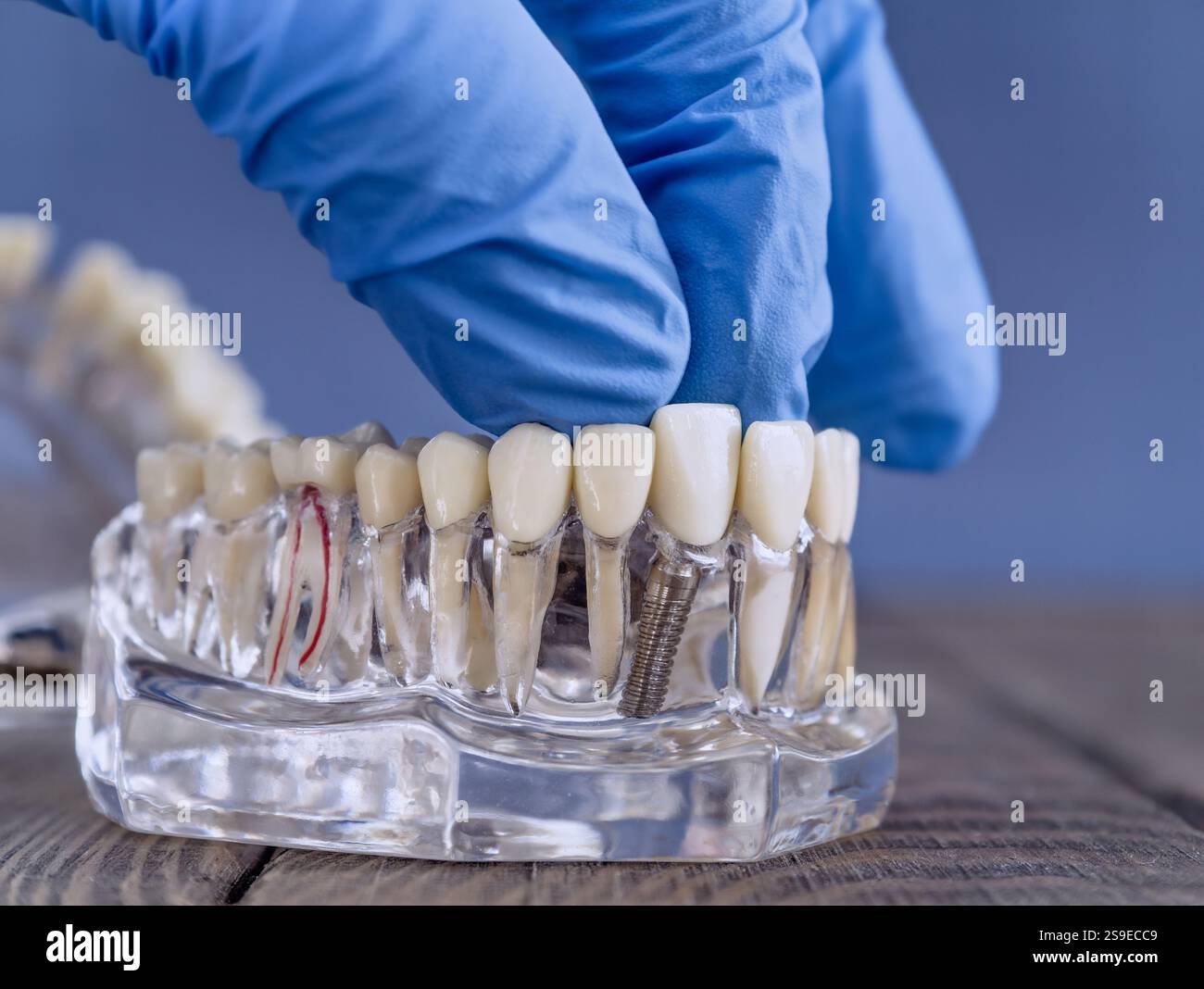 Side View of a Dental Implant Model with a Gloved Hand Adjusting Prosthetic Teeth on a ...
