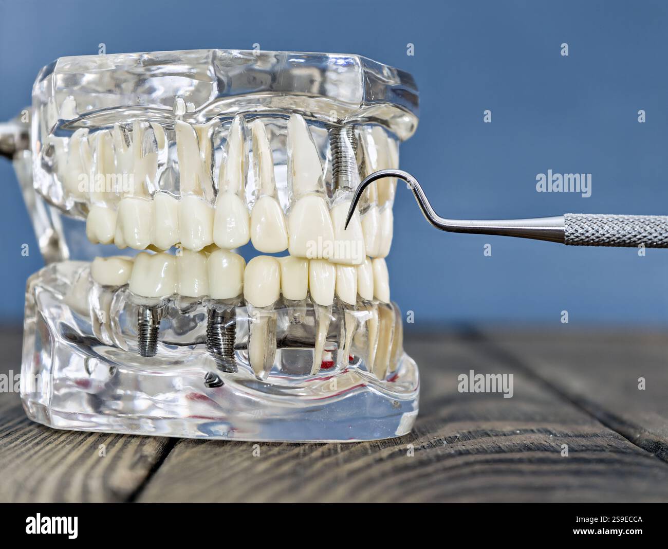 Transparent Dental Implant Model with Metal Dental Tool Demonstrating ...