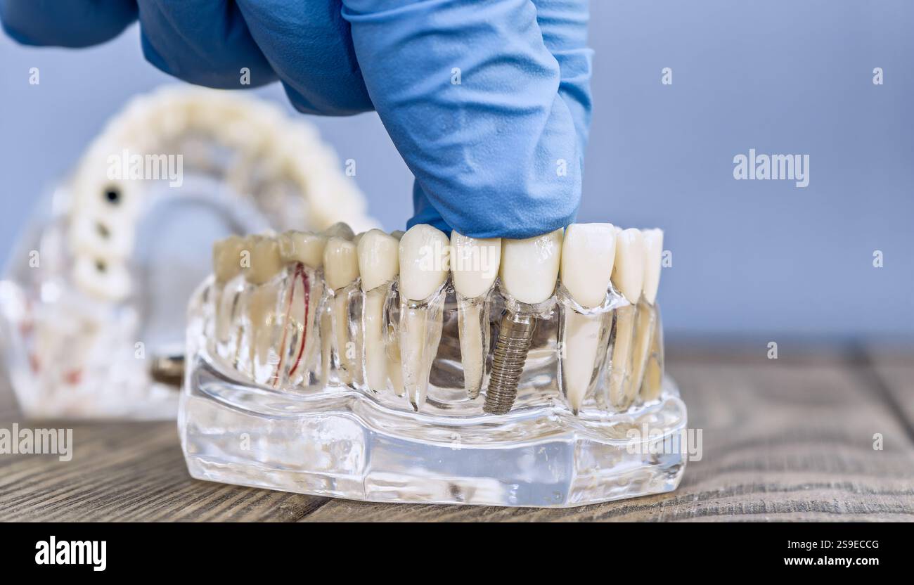 Close-Up of a Transparent Dental Implant Model with a Gloved Hand ...