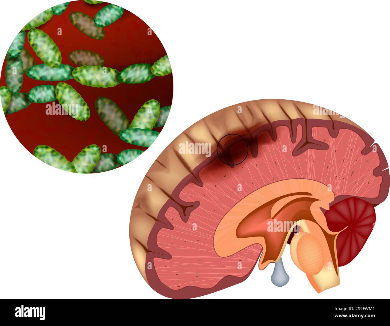 Bacterial Meningitis Cell Diagram Bacterial Meningitis