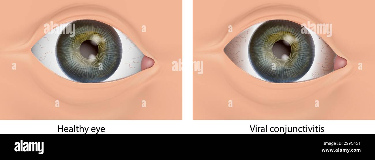 Healthy Eye and Viral Conjunctivitis Medical Comparison Stock Vector ...