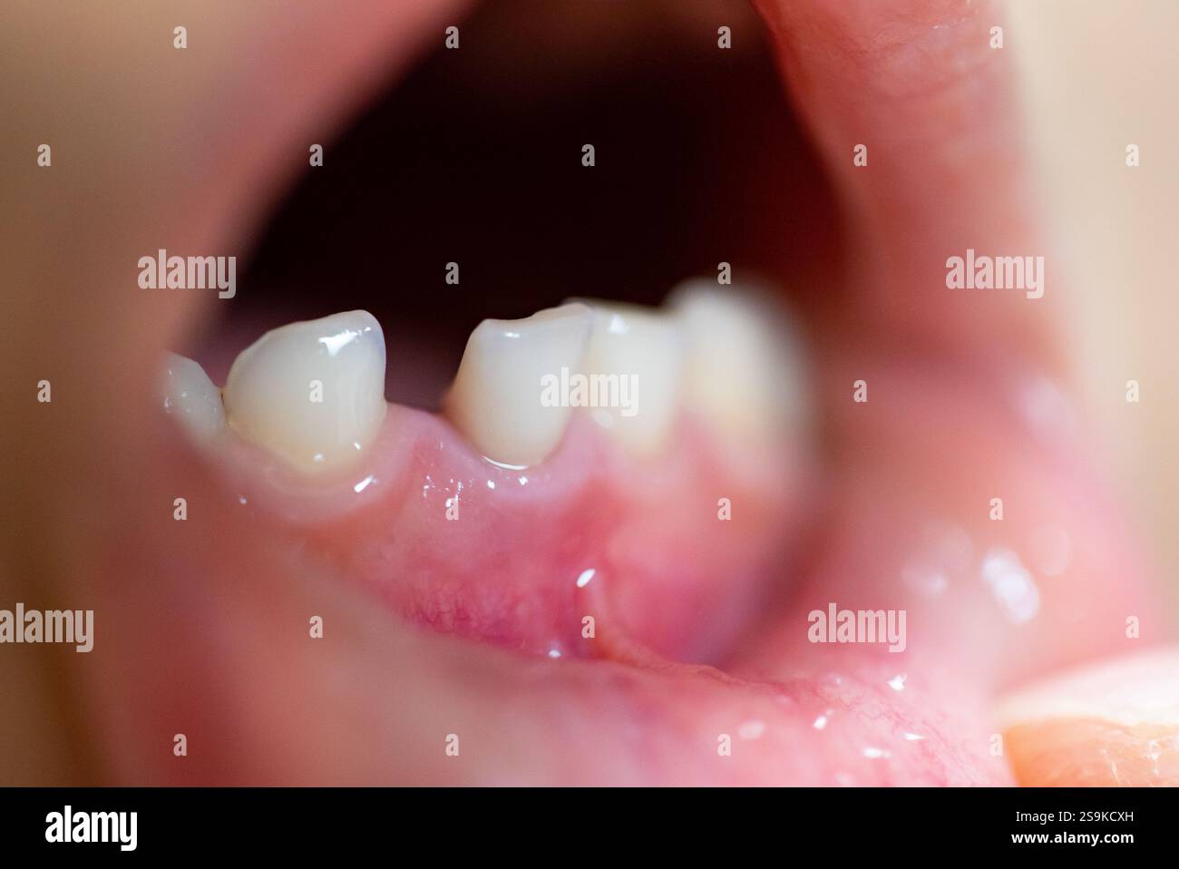 Wobbly child's front teeth (baby teeth Stock Photo - Alamy