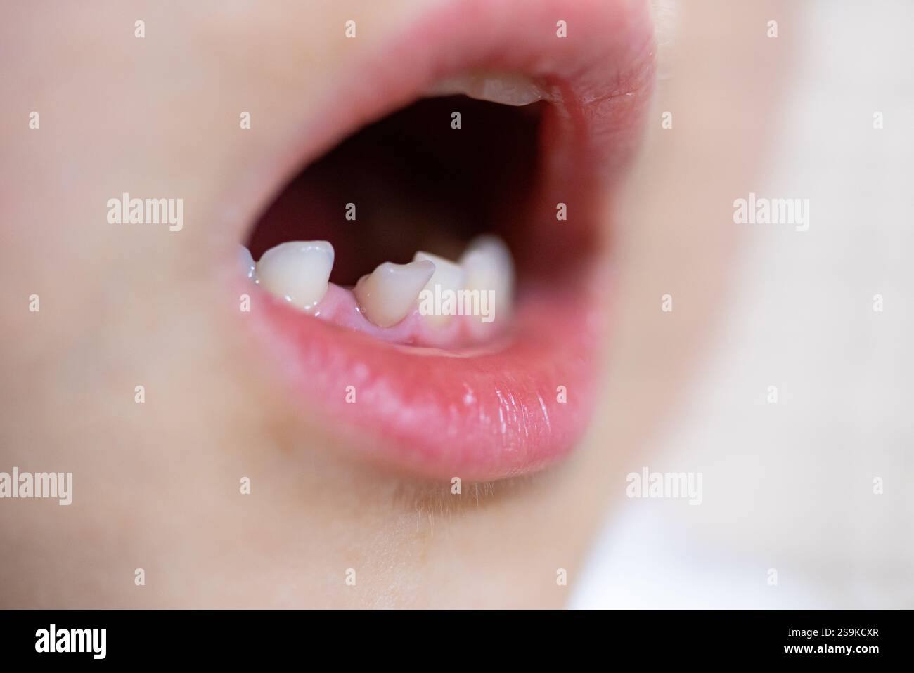 Wobbly child's front teeth (baby teeth Stock Photo - Alamy