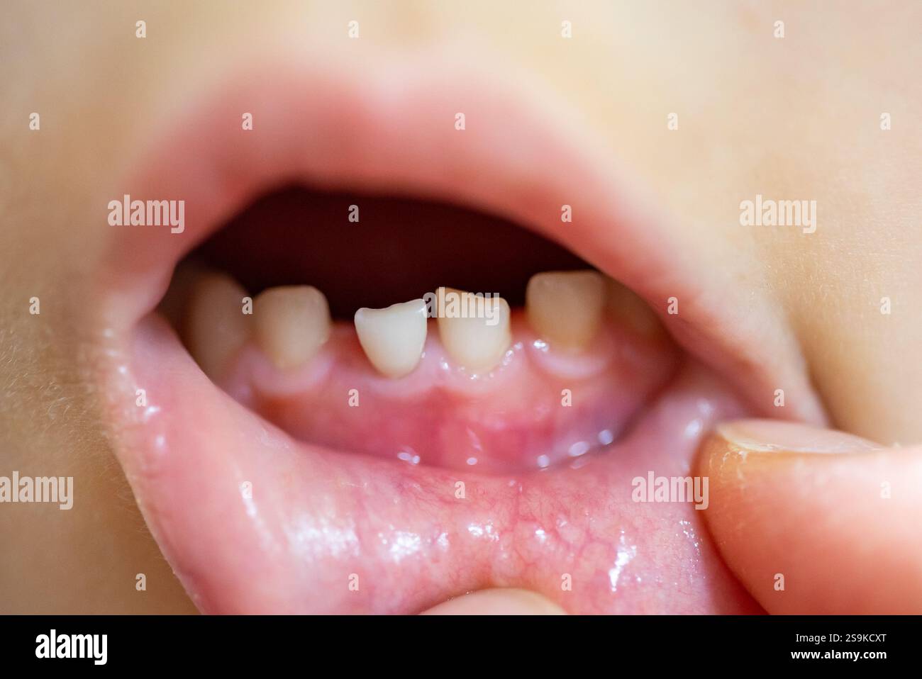 Wobbly child's front teeth (baby teeth Stock Photo - Alamy