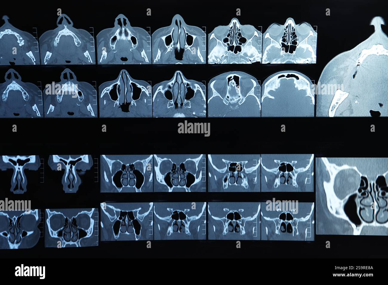 X-ray image of paranasal sinuses as background Stock Photo - Alamy