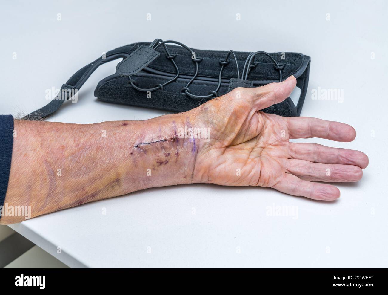 A hand with a visible surgical scar on the wrist shows signs of healing ...