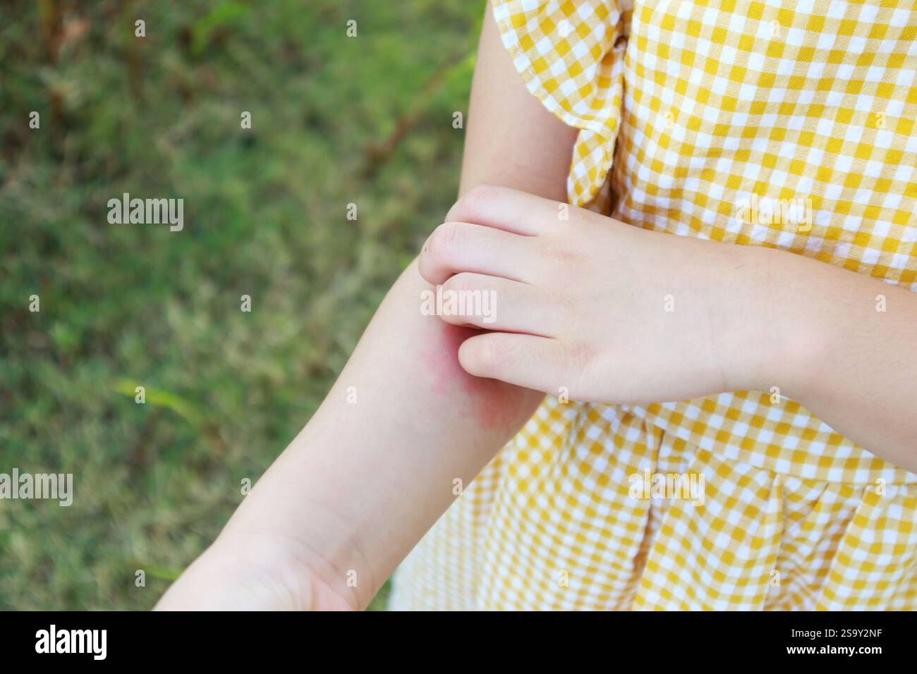 Little girl has skin rash allergy and itchy on her arm Stock Photo - Alamy