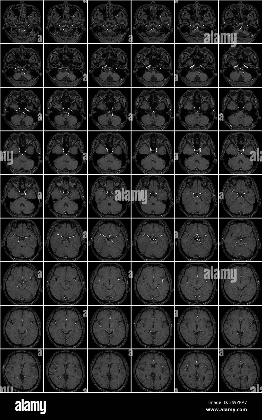 Mri brain consultation Black and White Stock Photos & Images - Alamy